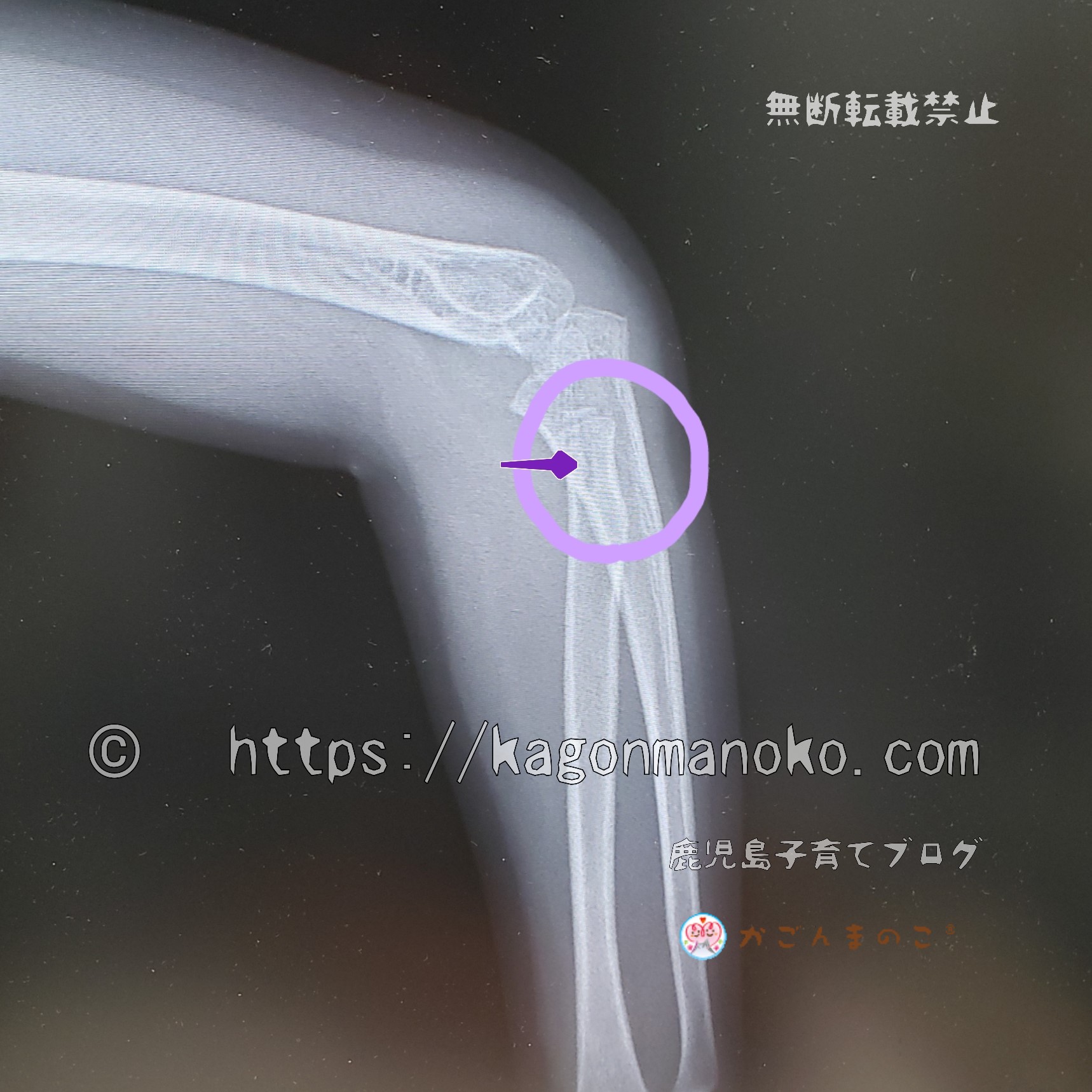 肘骨にヒビが入った時の診察と完治までの痛みや早く治す過ごし方 かごんまのこ|家族が笑顔で、元気に、楽しく暮らすための子育てライフ